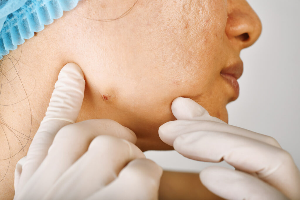 Precision Cyst Removal in Upper Arlington, OH