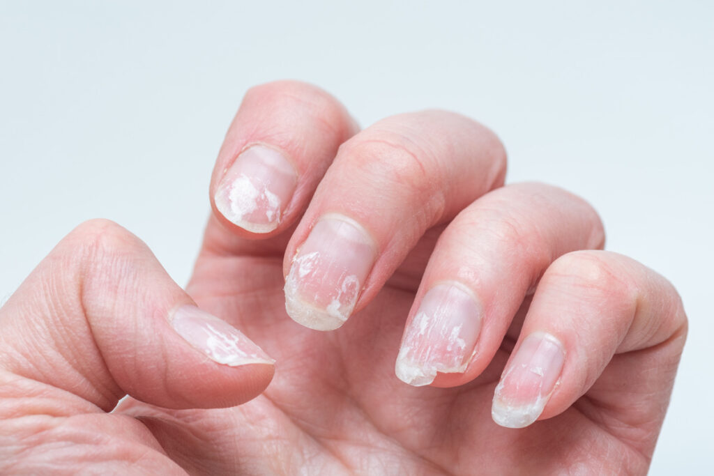 Specialized Nail Disorder Treatment in Upper Arlington, OH